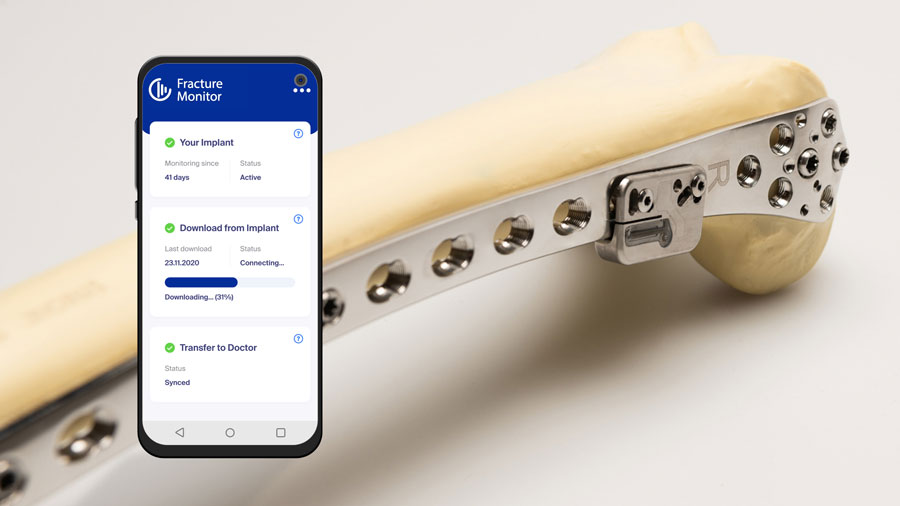 Patient convalescing following first-in-human AO Fracture Monitor ...