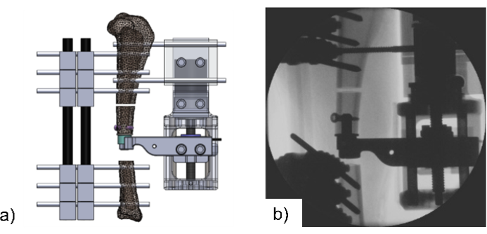 The influence of temporal fracture mechanics modulation on bone healing ...