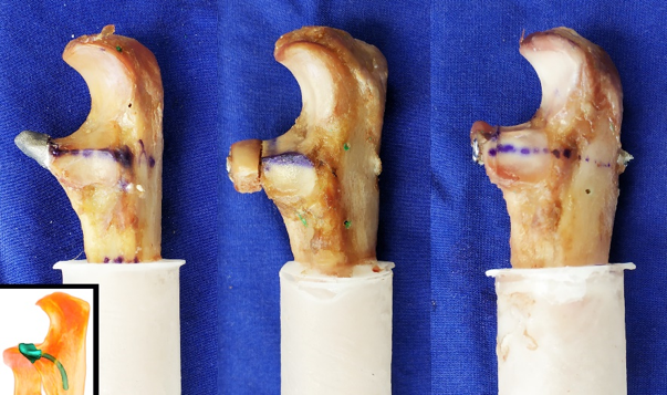 Coronoid process replacement with individually designed 3D printed ...