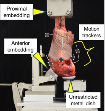 Analysis of three different screw configurations for fixation of ...
