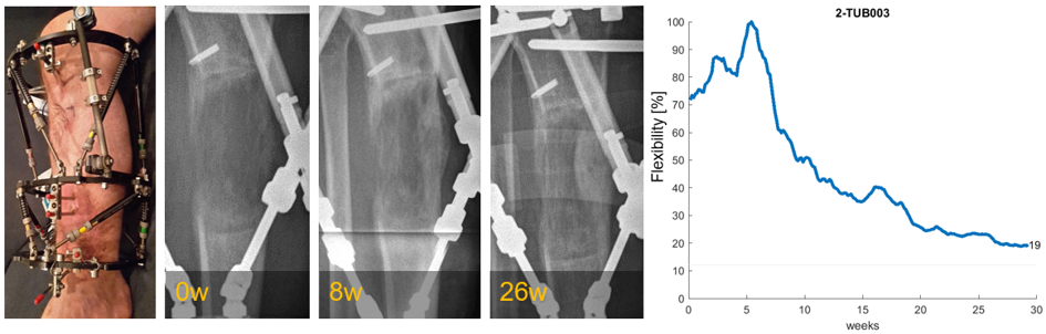 AO Fracture Monitor – Clinical data collection on external fixator ...