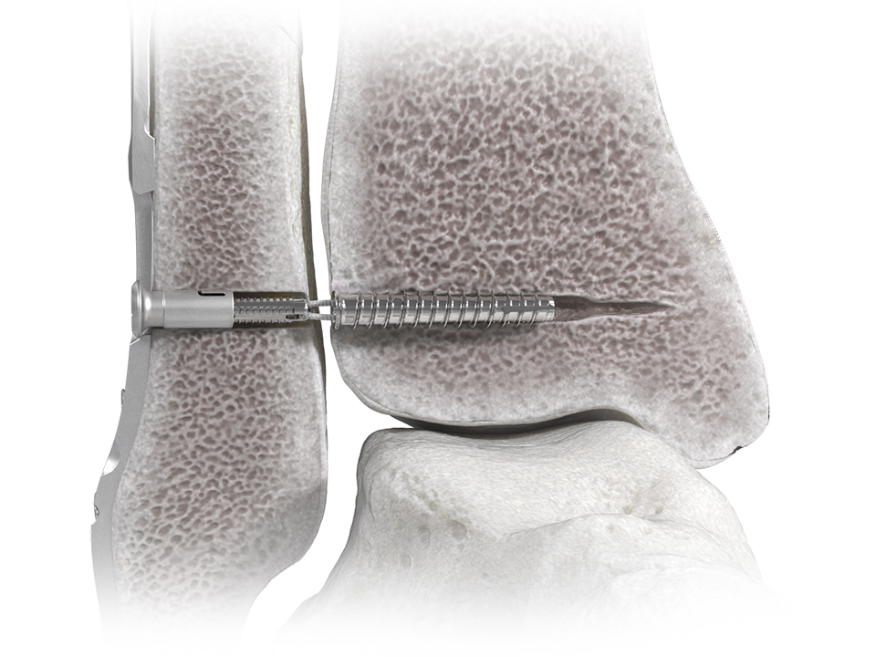 FIBULINK Syndesmosis Repair System