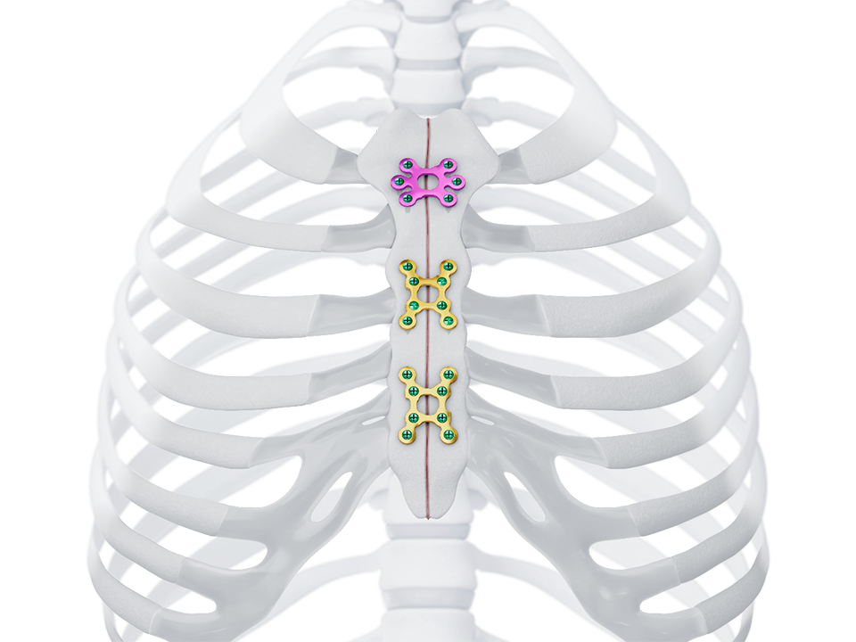 MatrixSTERNUM™ Fixation System