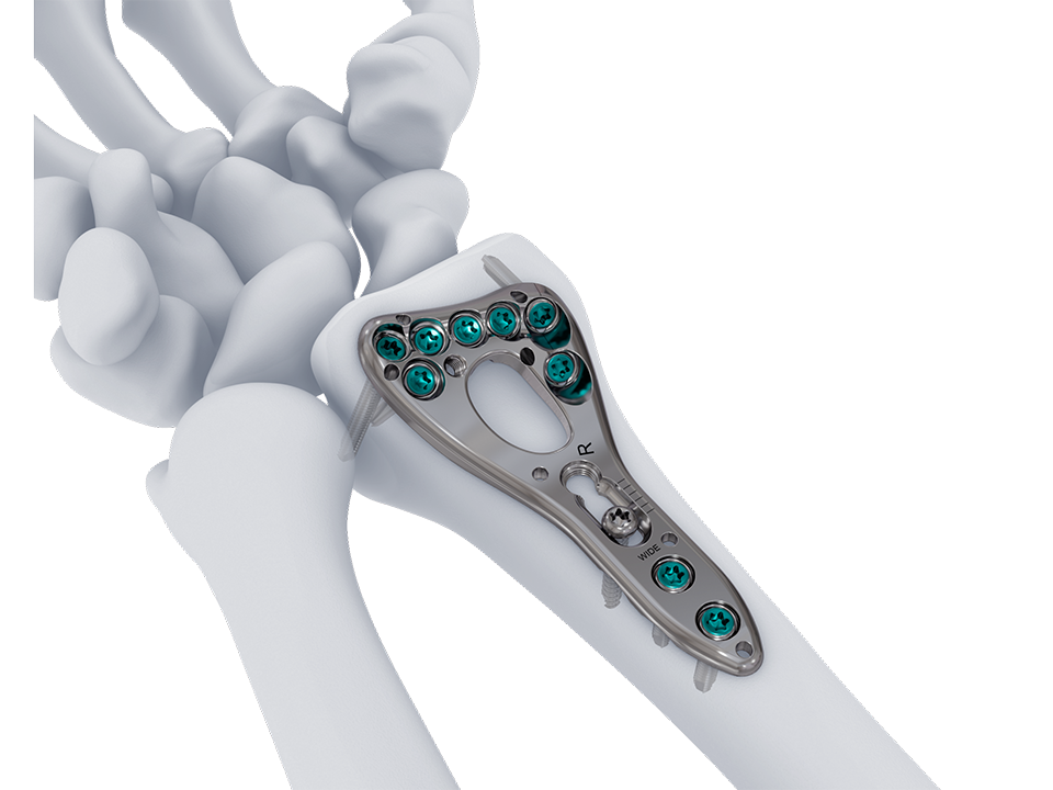 VOLT™ Wrist Treatment System: Two-Column Distal Radius Plates