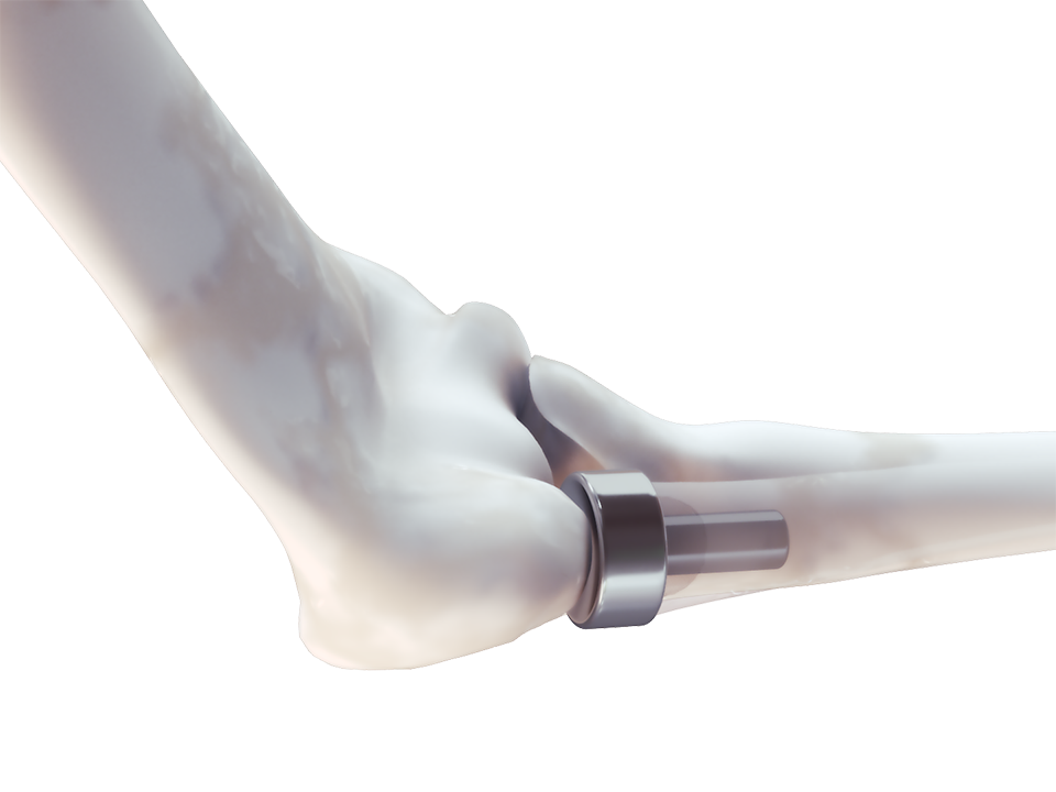 Radial Head Replacement System