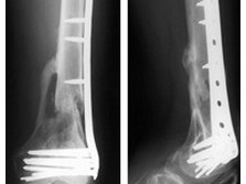 LISS Distal Femur: Study Results