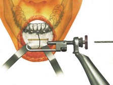 Universal Trocar Device incl. Lag Screw Device