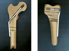 Variable Angle Guide for DHS