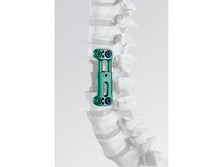 Anterior Telescoping Fixation System (TeleFix)