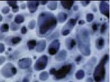 Bone substitution materials: chronOs, CEROS