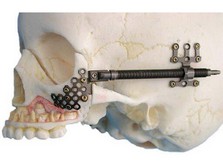Internal Midface Distractor System