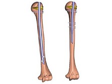 Expert Cannulated Humeral Nail