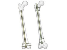 Expert Retrograde / Antegrade Femoral Nail (R/AFN)