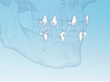 Rapid IMF System - Temporary Mandibular Fixation Device
