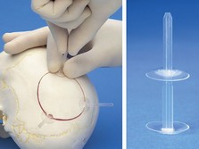 Resorbable Cranial Clamp