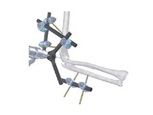 Elbow Hinge Fixator