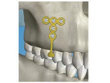 Orthodontic Bone Anchor