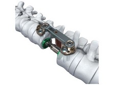 ArcoFix and Synex II: the AOSpine Anterior Fracture Solution
