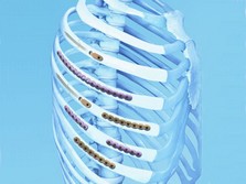 MatrixRIB Fixation System