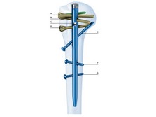 MultiLoc Proximal Humeral Nail