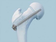 Slipped Capital Femoral Epiphysis (SCFE ) Screw System