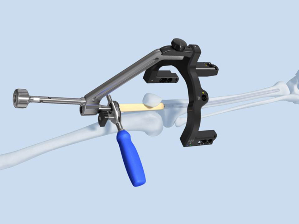 Suprapatellar Insertion Instruments