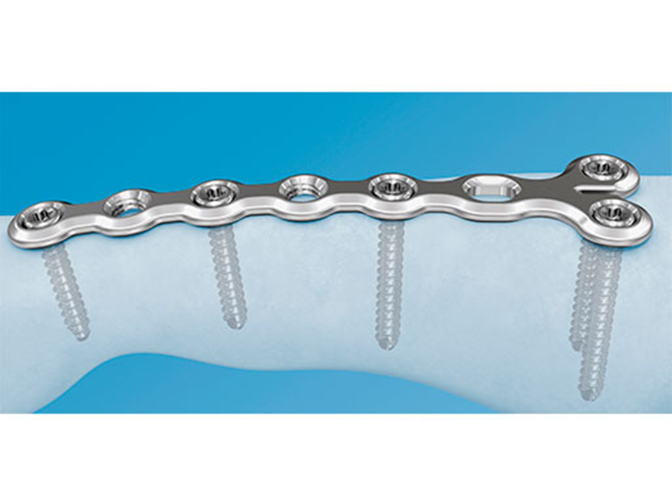 Locking Compression Plate 1.5 System