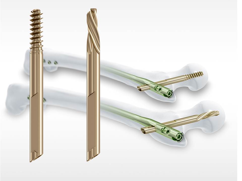 TFN-ADVANCED Proximal Femoral Nailing System (TFNA)