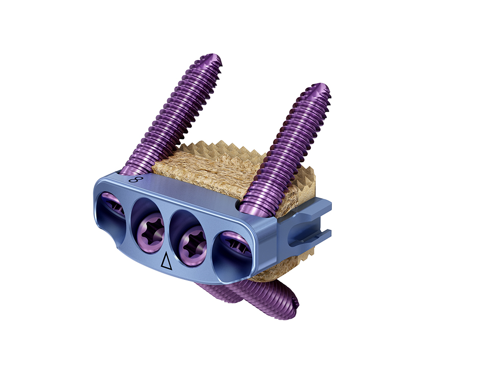 Zero-P Natural Anterior Cervical Plate