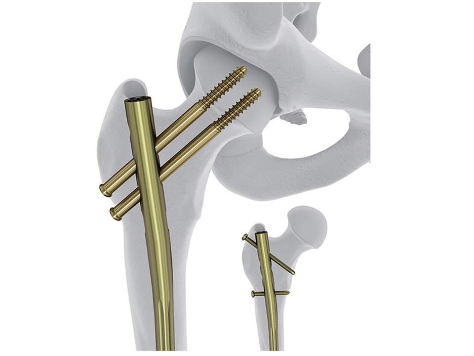 Femoral Recon Nail System