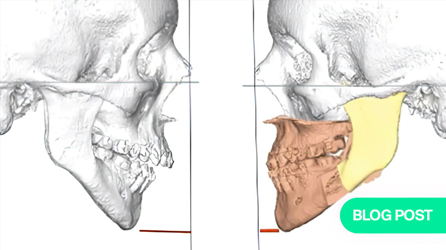 The maxilla-first approach in orthognathic treatment for predictable ...