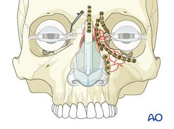 AO Surgery Reference CMF publishes long-awaited revised Midface surgery ...