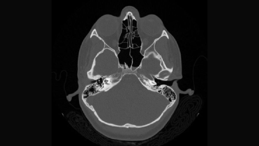 CTRead—Facial Bones: AO CMF launches new web-based learning tool for ...