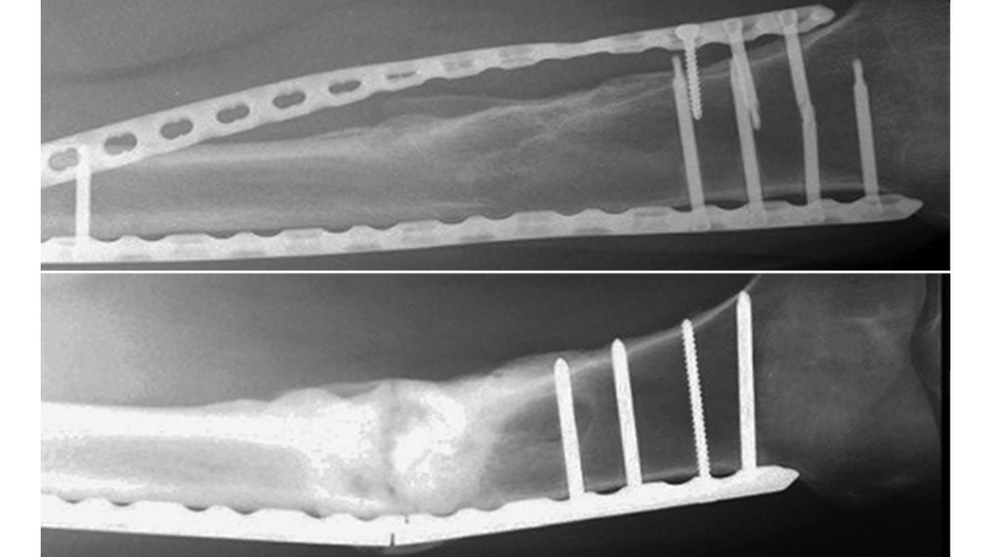 Helical plating provides well-balanced load sharing in laterally plated ...