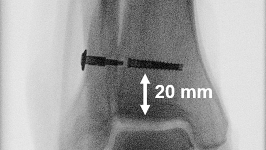 Biomechanical investigation of Fibulink for syndesmotic repair