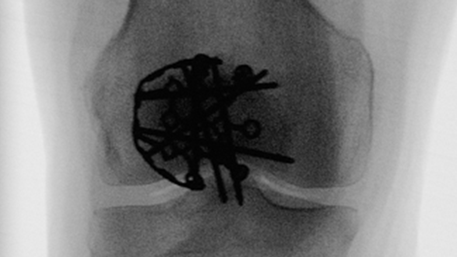 Locked lateral plating vs. tension band wiring in patella fractures