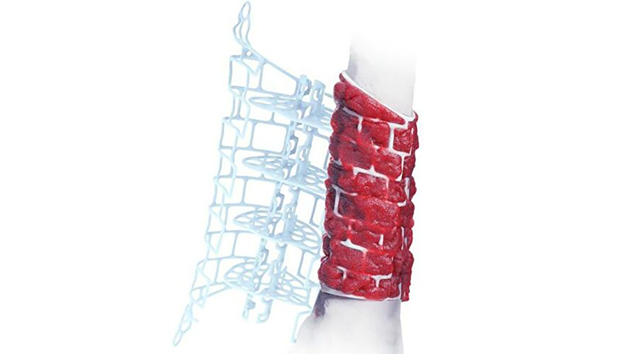 TRUMATCH™ Graft Cage – Long Bone