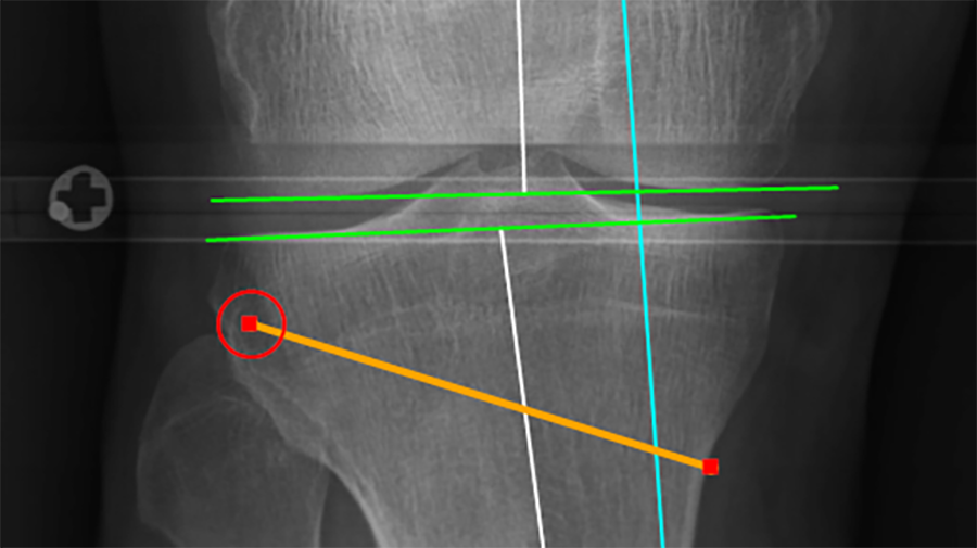 Automated Deformity Analysis and Osteotomy Planning Tool in the Coronal ...