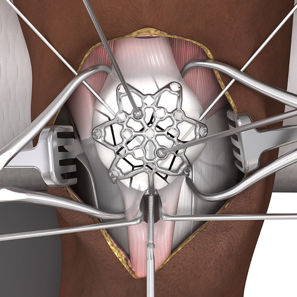 patella fixation surgery