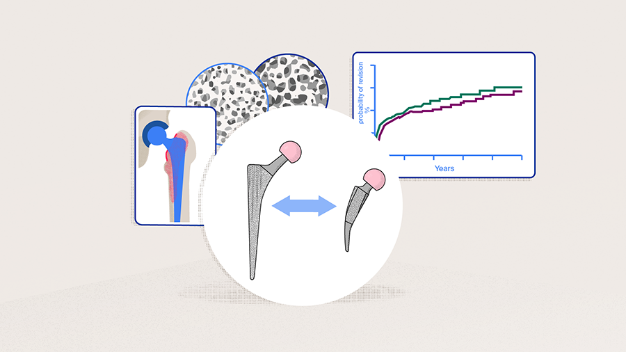 Clinical performance of short versus conventional stems in primary ...