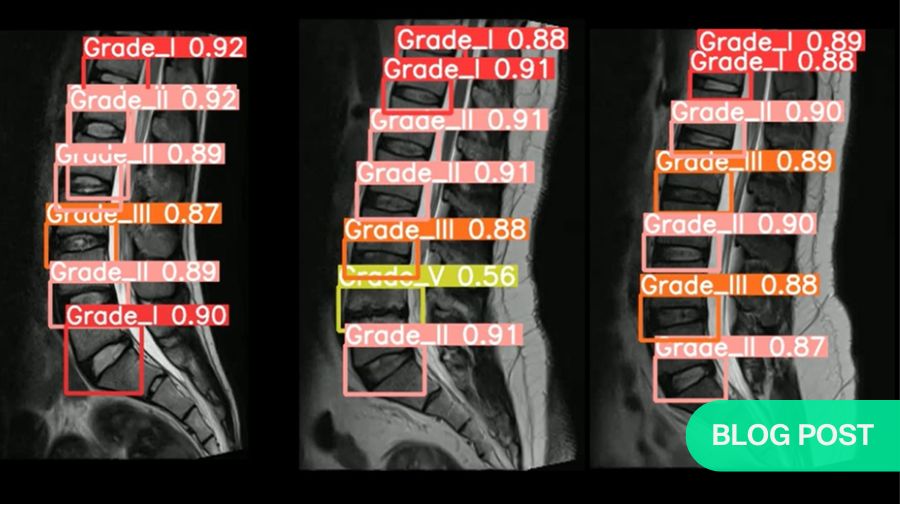 Understanding Machine Learning in Spine Research