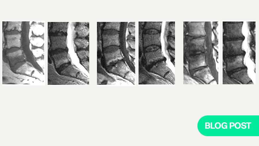 Modic Changes in spine surgery: clinical update 2025
