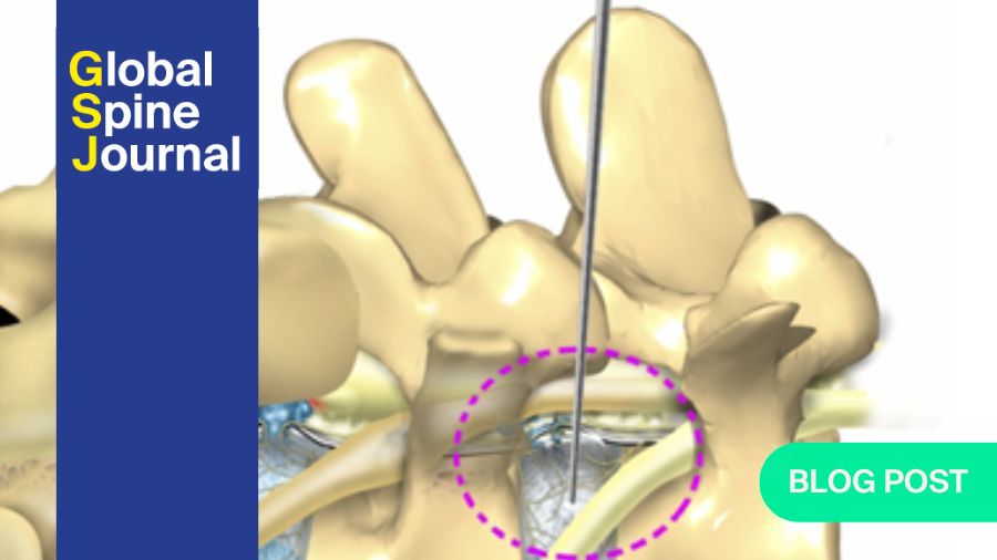 How good is trans-Kambin TLIF with a large-footprint interbody compared ...