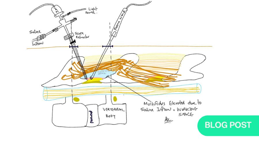 Unilateral Biportal Endoscopy (UBE): Why spine surgeons should make the leap and master the skills