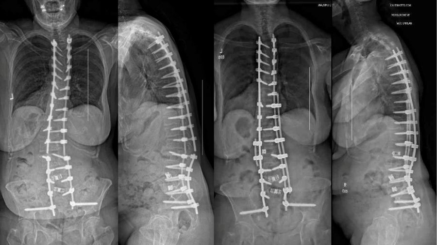 AO Spine Knowledge Forum Deformity launches study on supplementary rod ...