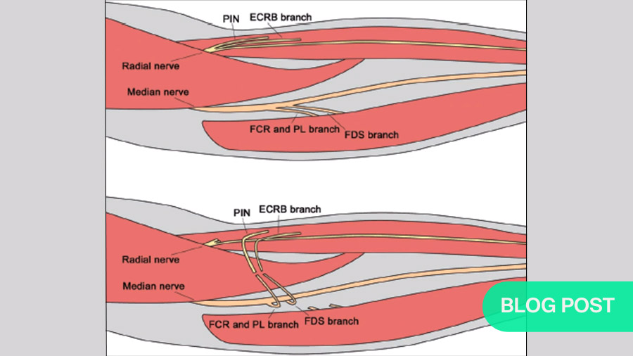 Radial Nerve Palsy Following Humeral Fractures