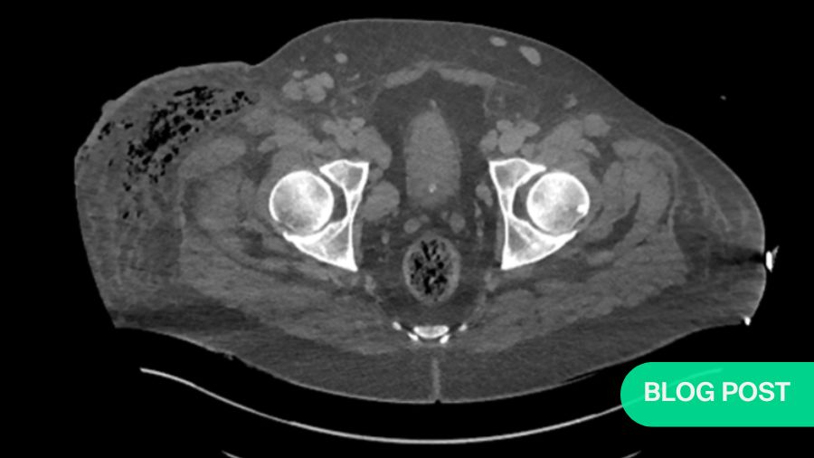 leg necrotizing fasciitis treatment