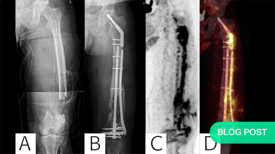 Fracture-related infection: Consensus recommendations on diagnosis and ...