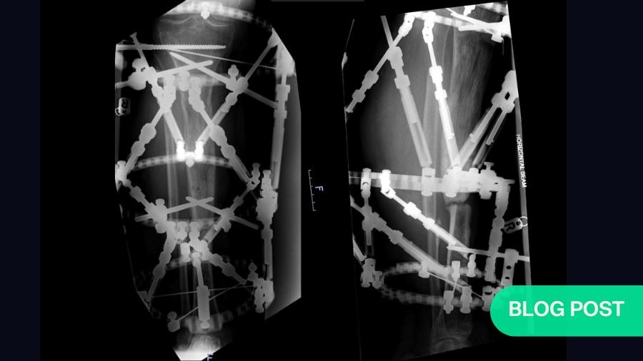 Open bone fractures—limb salvage or amputation? Putting ourselves in ...