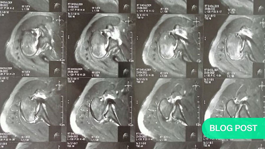 dislocated shoulder surgery